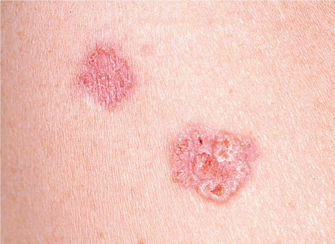 Verdachte huidplekjes – GC Samen Gezond – Malden